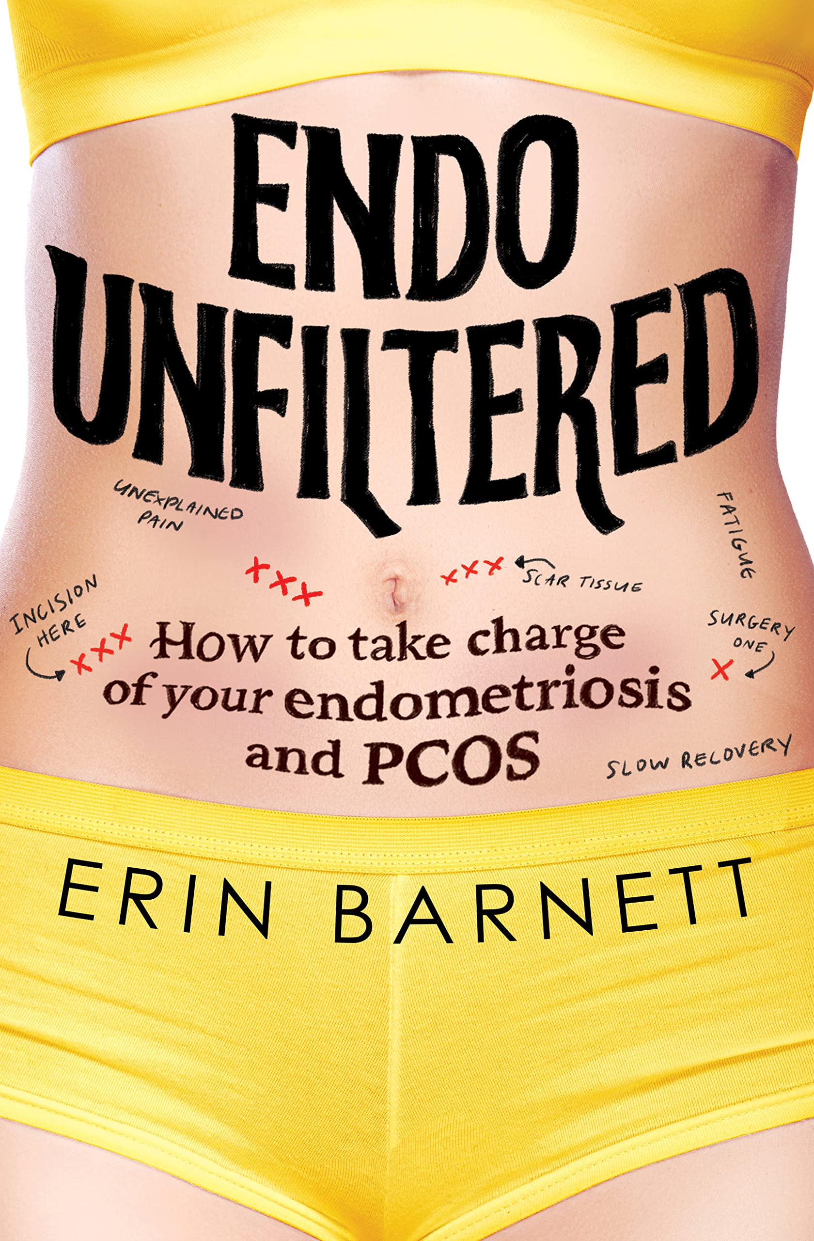 Endo Unfiltered: How to take charge of your endometriosis and PCOS ...