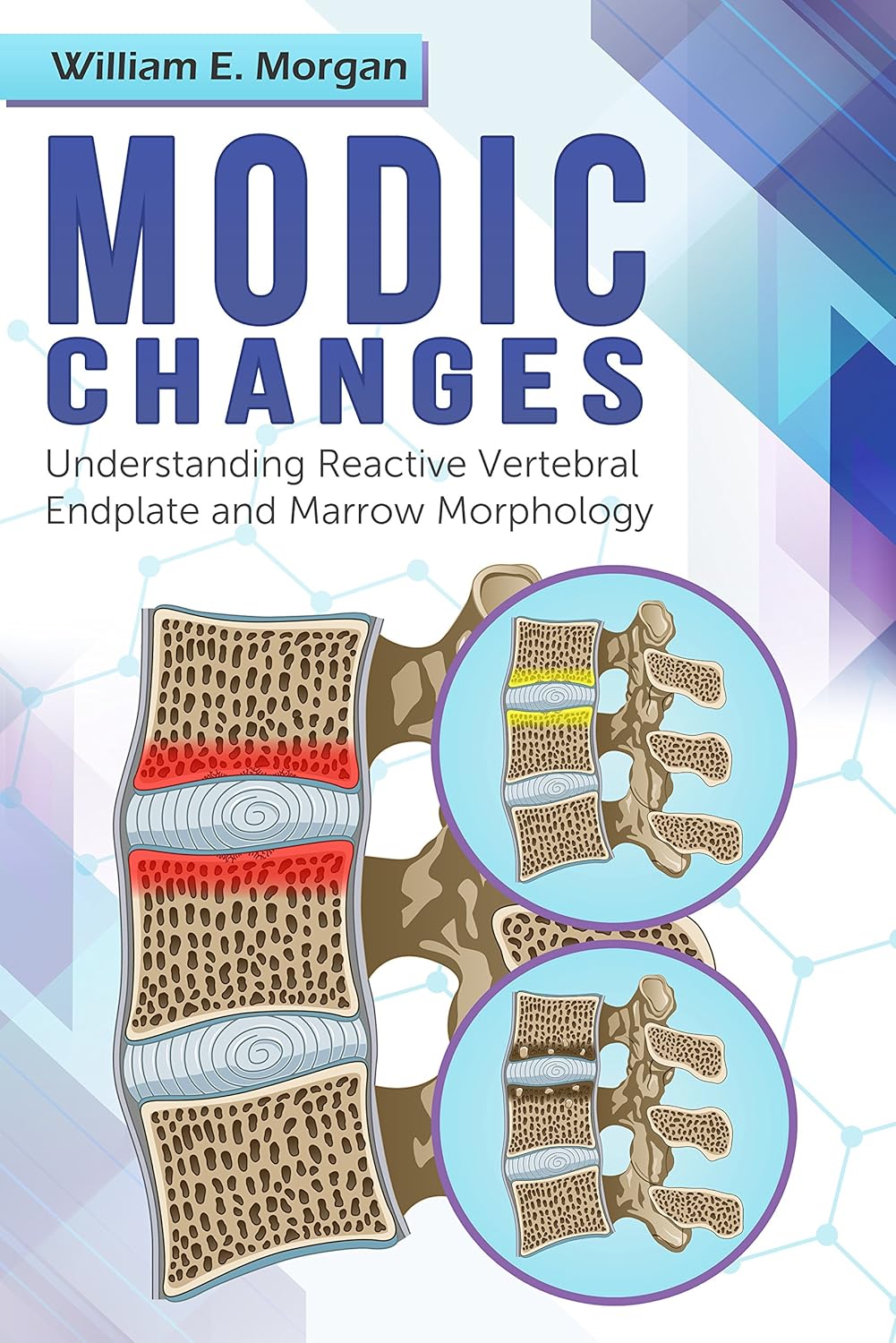 Modic Changes: Understanding Reactive Vertebral Endplate and Marrow ...