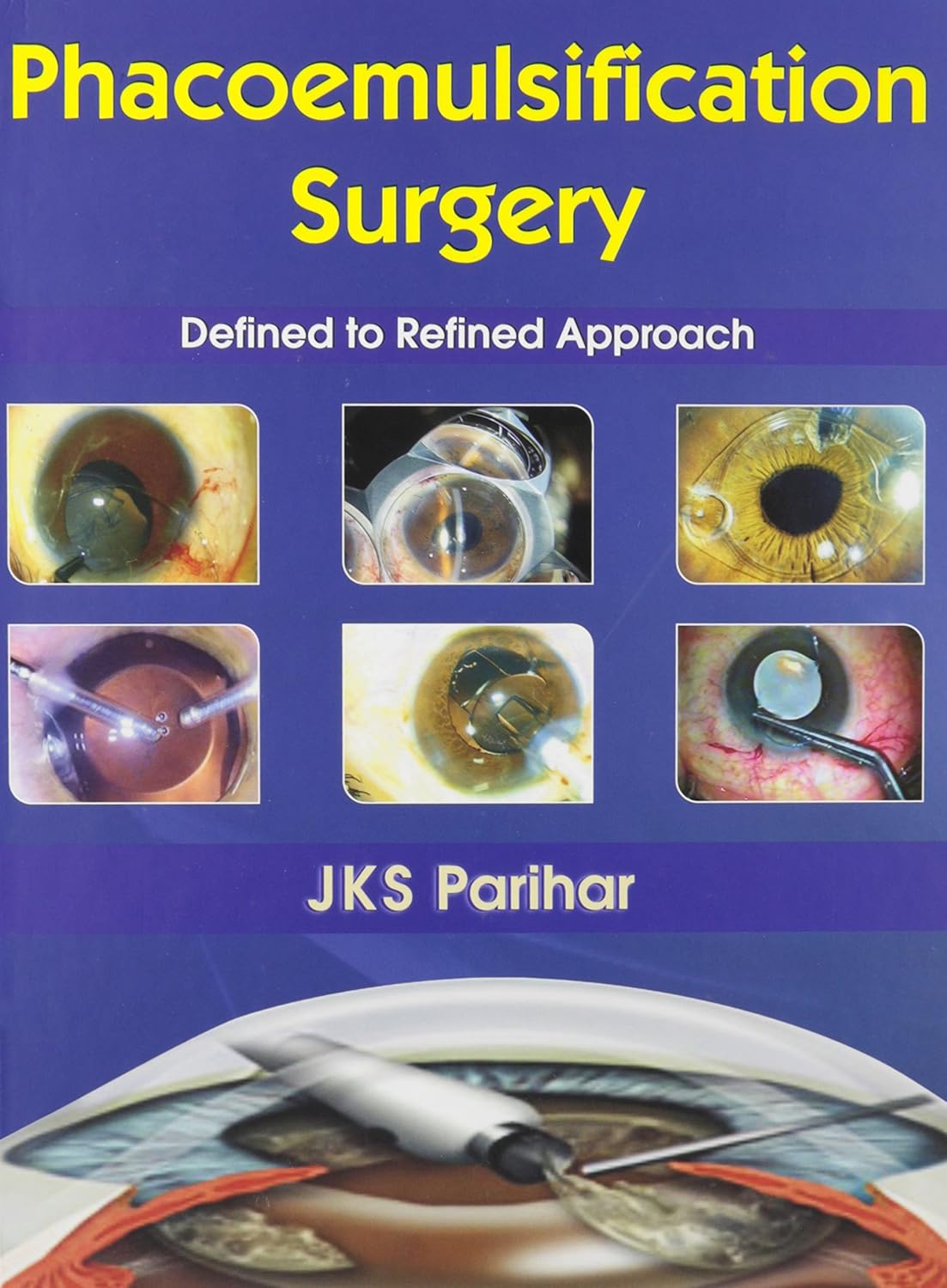 Buy PHACOEMULSIFICATION SURGERY DEFINED TO REFINED APPROACH (HB 2011) Book Online at Low Prices ...