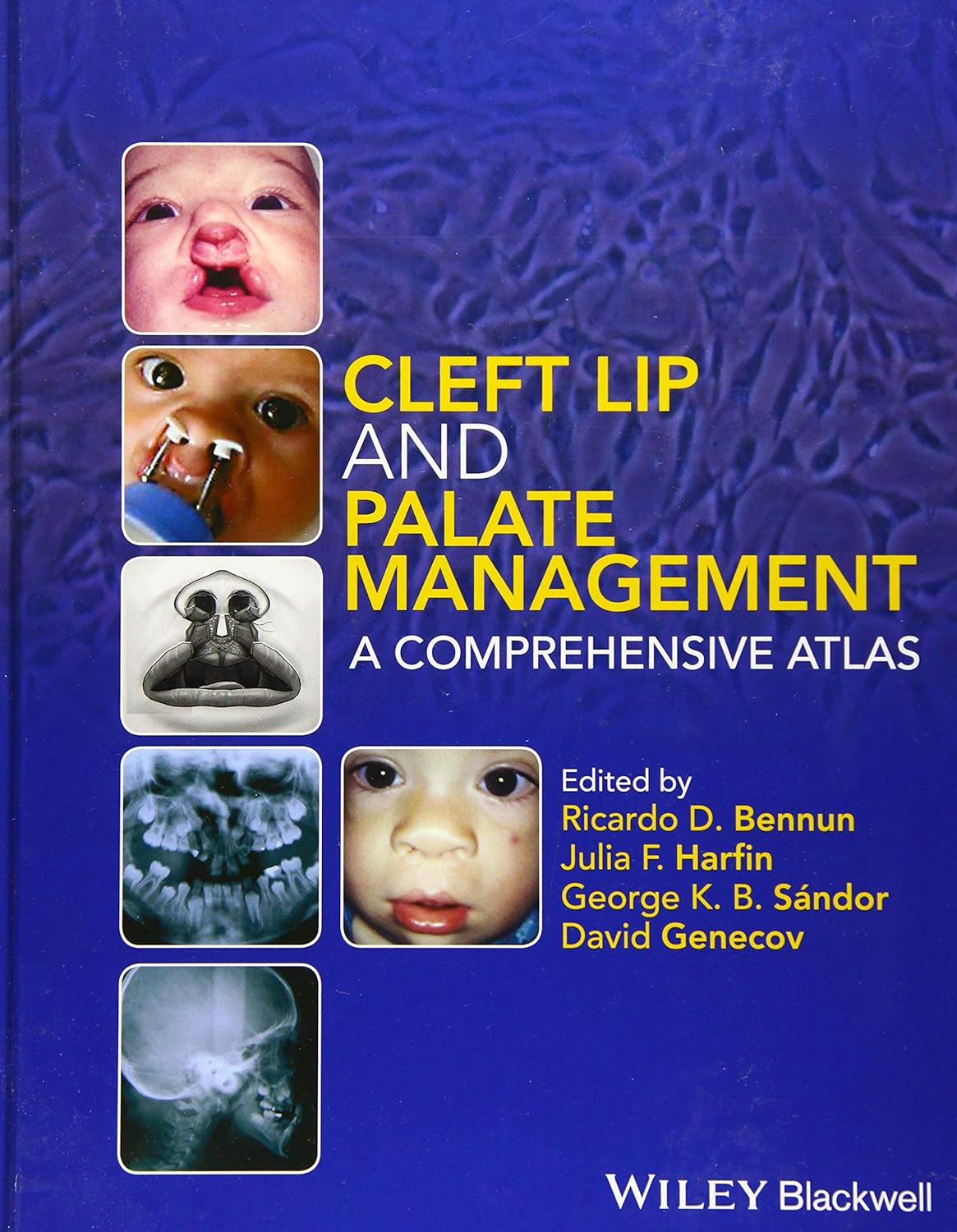 Cleft Lip and Palate Management: A Comprehensive Atlas: 9781118607541 ...