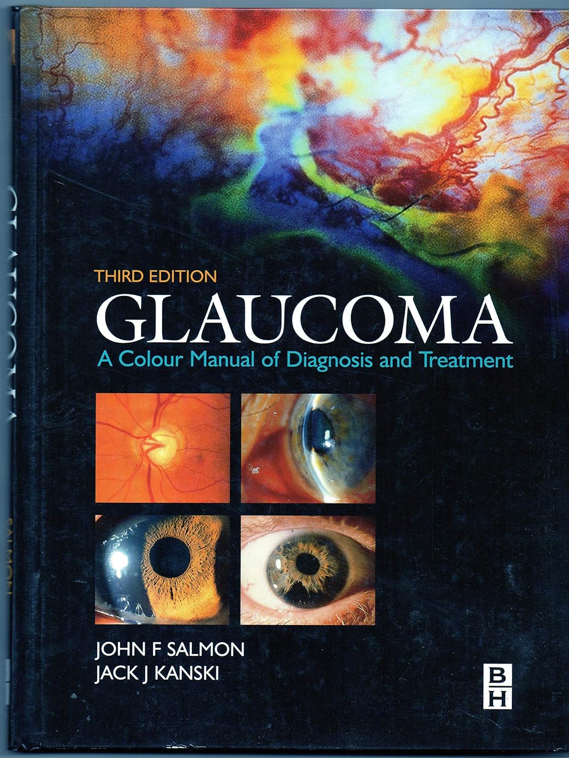 Glaucoma: A Colour Manual of Diagnosis and Treatment: Amazon.co.uk ...