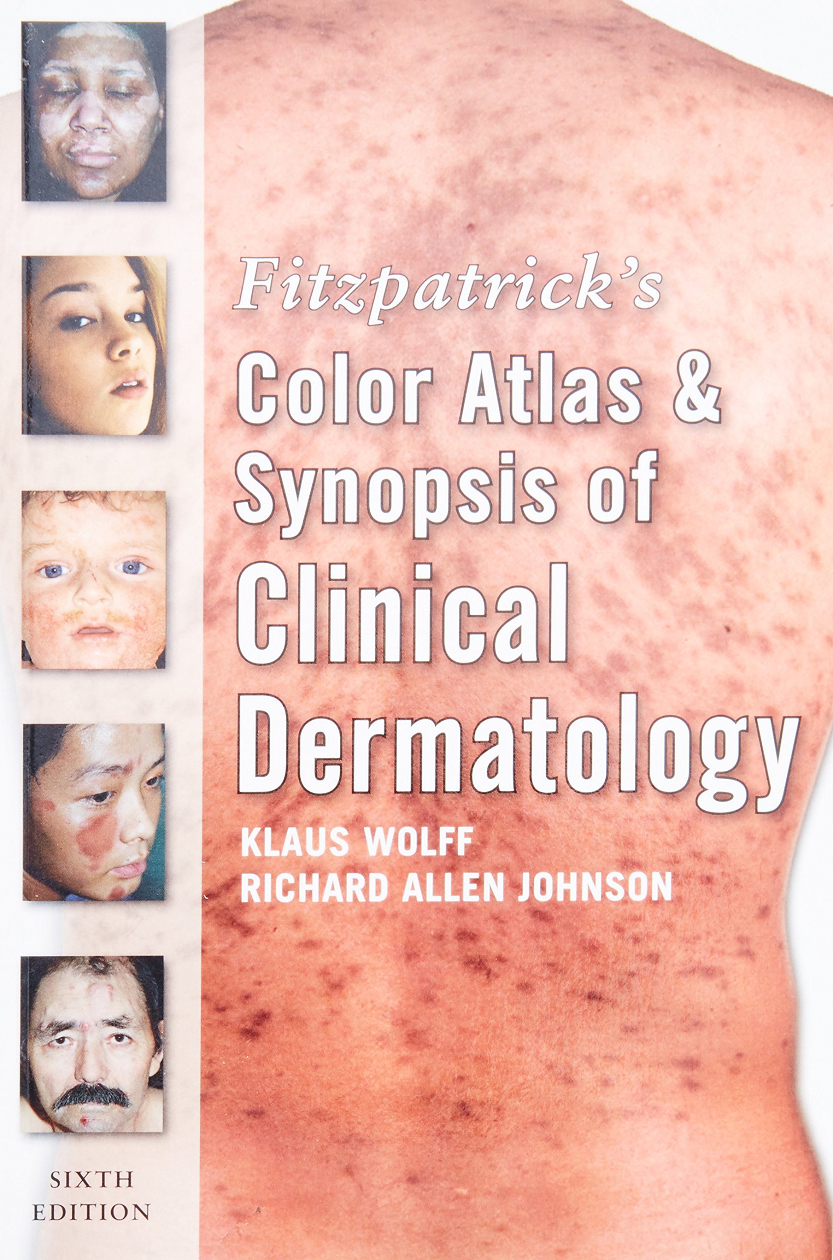 Fitzpatrick's Color Atlas and Synopsis of Clinical Dermatology: Sixth ...