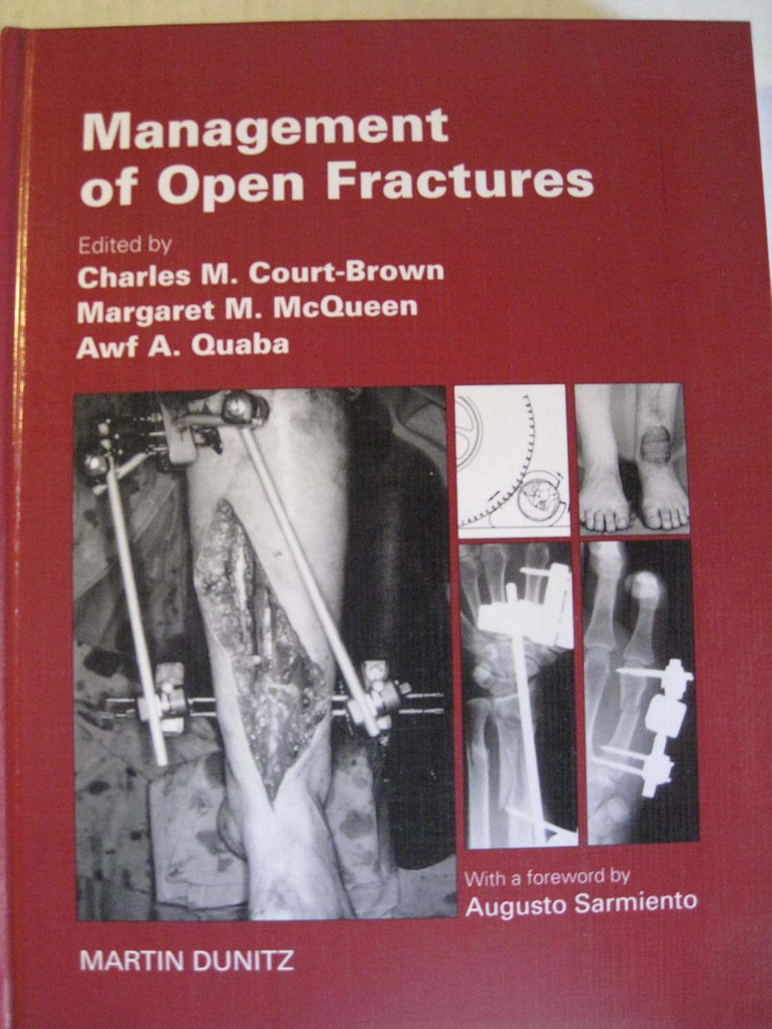 Buy Management of Open Fractures Book Online at Low Prices in India ...