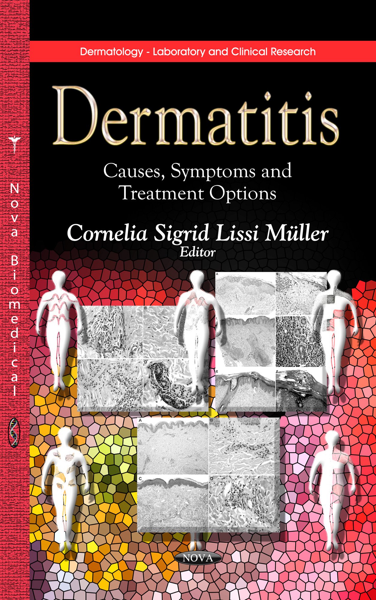 Dermatitis: Causes, Symptoms and Treatment Options (Dermatology ...