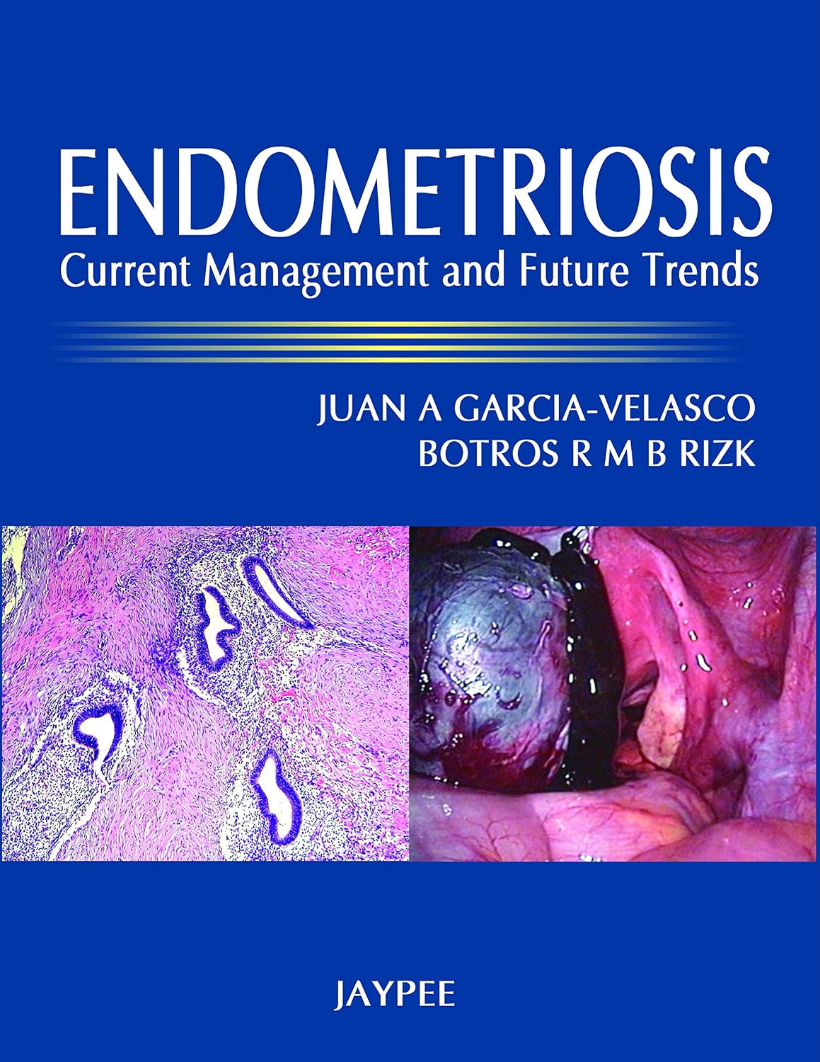 Amazon.com: Endometriosis: Current Management and Future Trends eBook ...