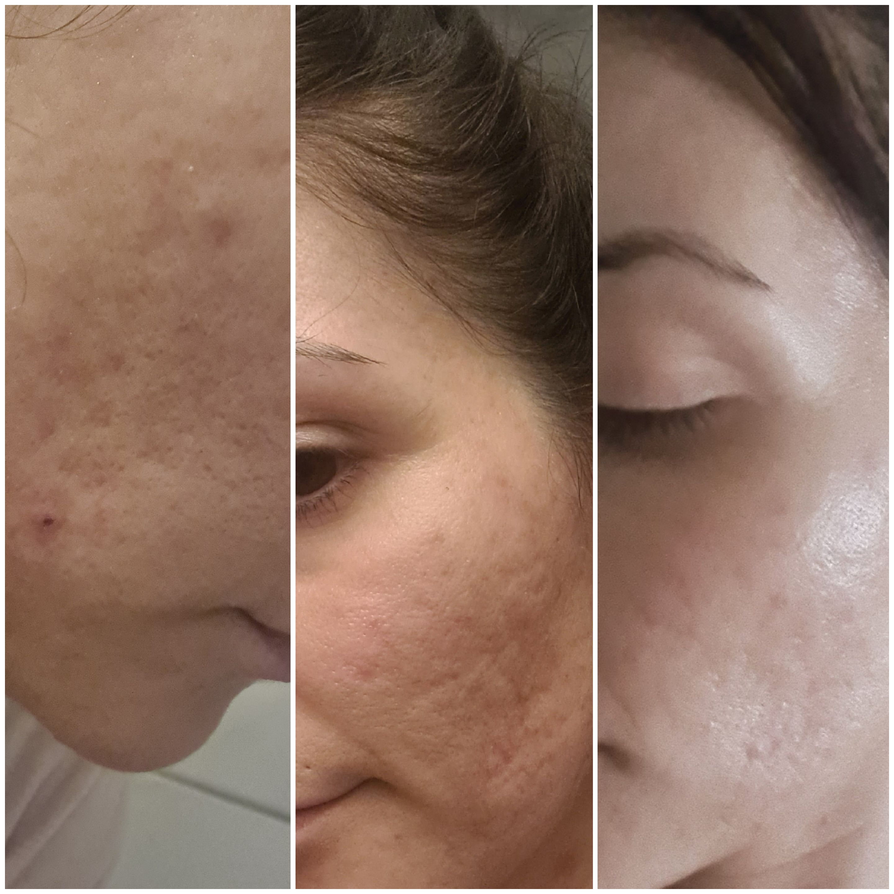 MADECASSOL ® 40 gr (Centella 1%) Creme gegen Narben, Flecken ...