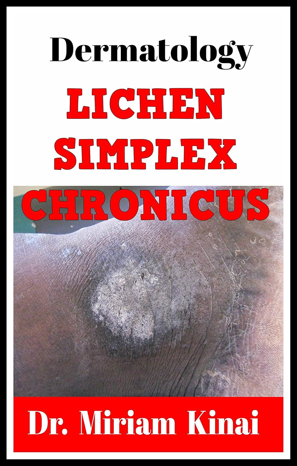 Amazon.co.jp: Dermatology: Lichen Simplex Chronicus: Neurodermatitis ...
