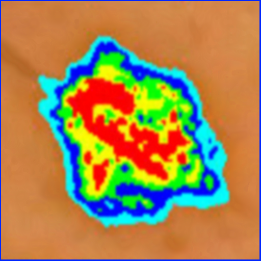 Skin Mole Analysis - App on the Amazon Appstore