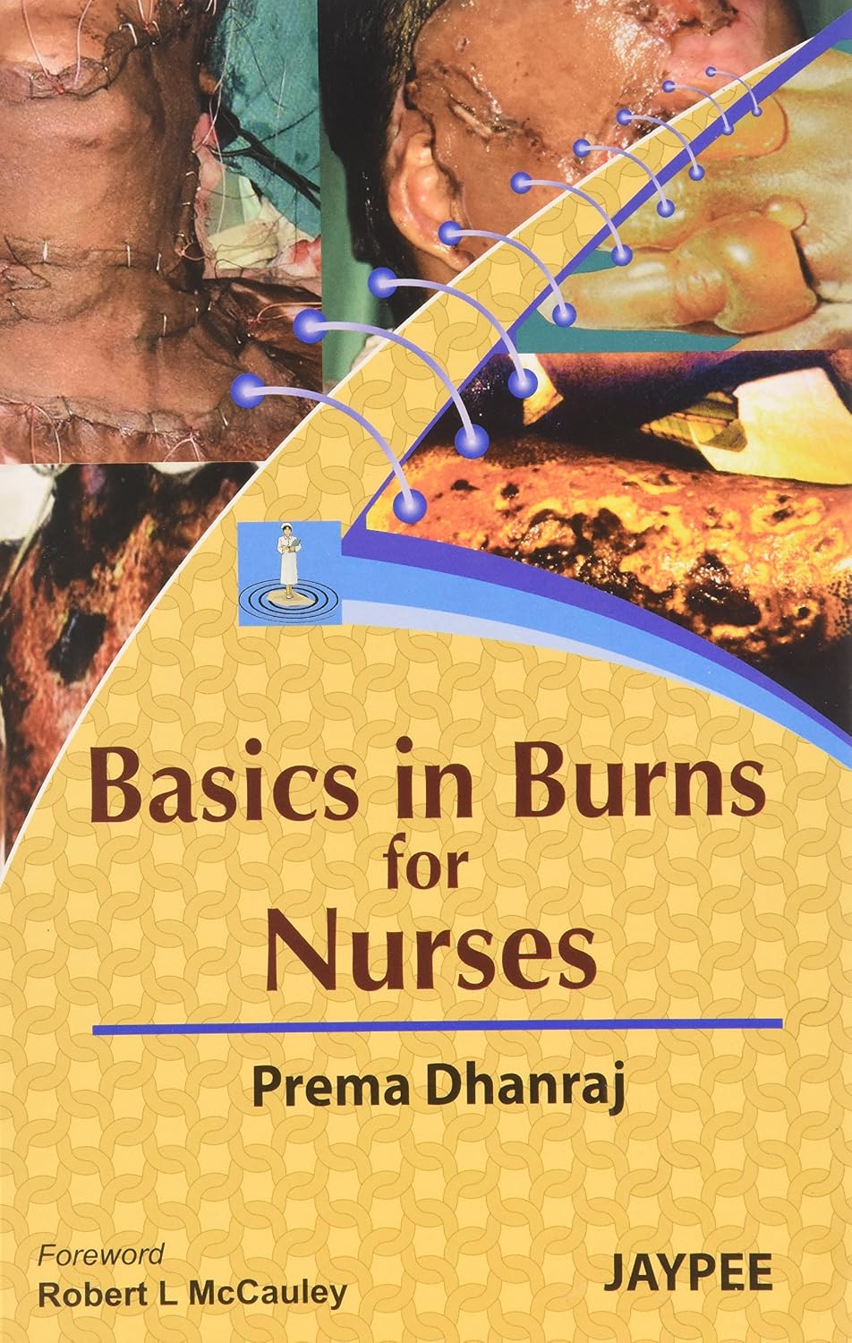Basics in Burns for Nurses: Dhanraj: 9789350250686: Amazon.com: Books
