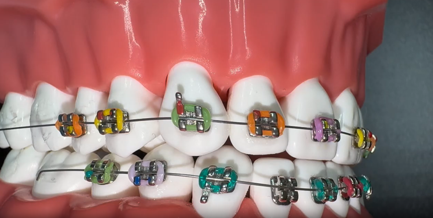 Colores De Brackets