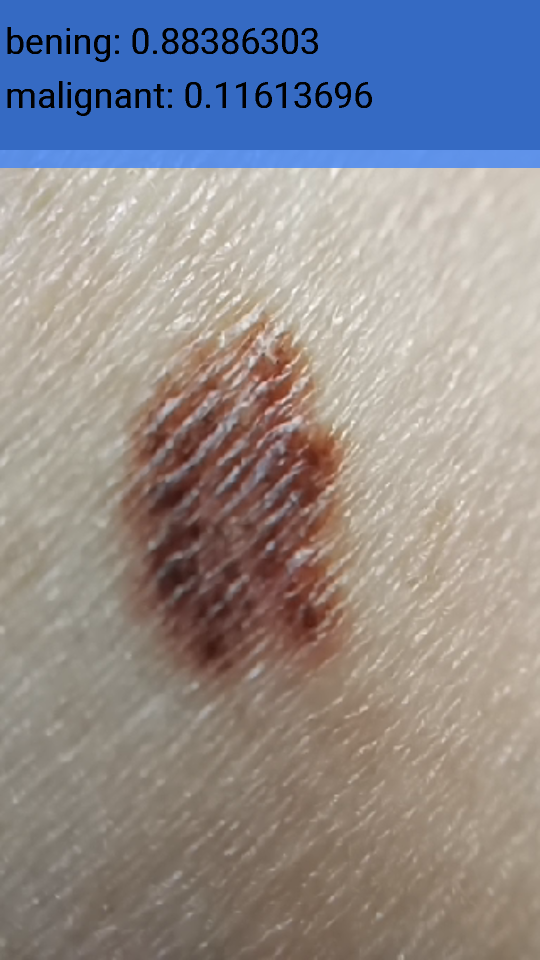 MoleScreener - Melanoma Skin Cancer Screening Tool - App on Amazon Appstore