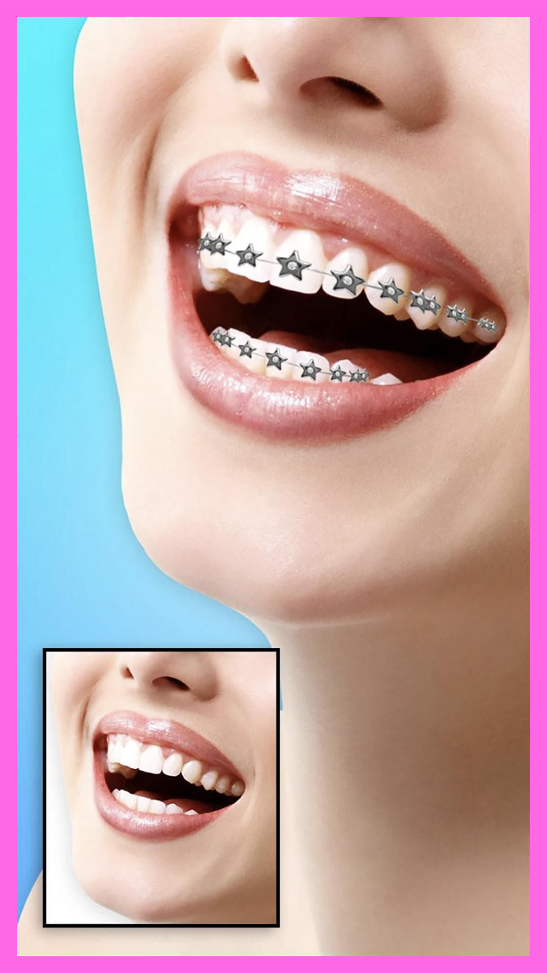 Braces Edit Face Stickers Photo - App on Amazon Appstore
