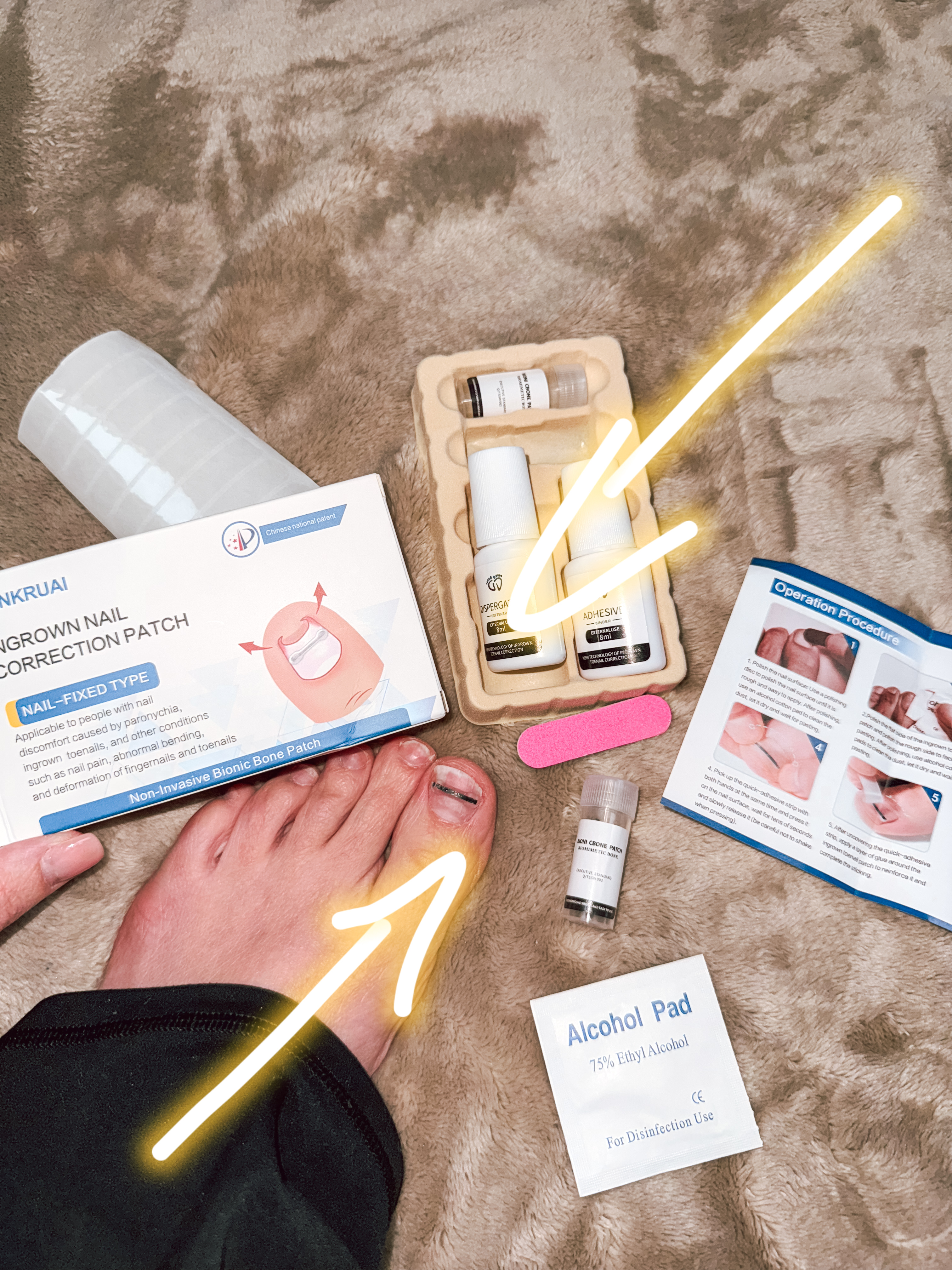 Watch My honest review and DEMO of this Ingrown toenail repair kit! on ...