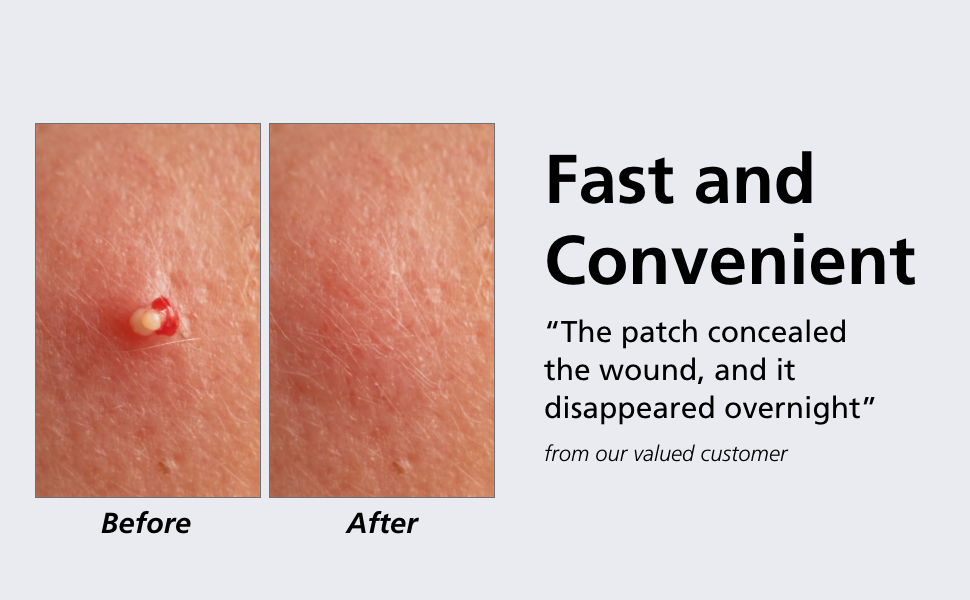 Amazon.com: EasyDerm Band Beauty 42 Counts - Hydrocolloid Pimple Patch ...