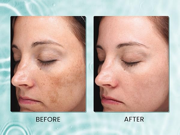 Mua Abera Melasma Serum, Melanin Correcting Facial Serum, Dark Spot Corrector for Age Spot Sun ...