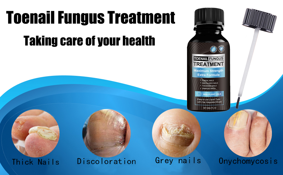 Amazon.com : Toenail Fungus Treatment Extra Strength,30ML Nail Fungus Treatment Extra Strength ...