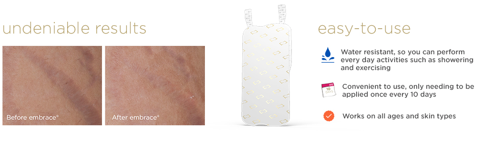Amazon.com: Embrace Stretch Marks Scar Treatment, Silicone Sheets for ...